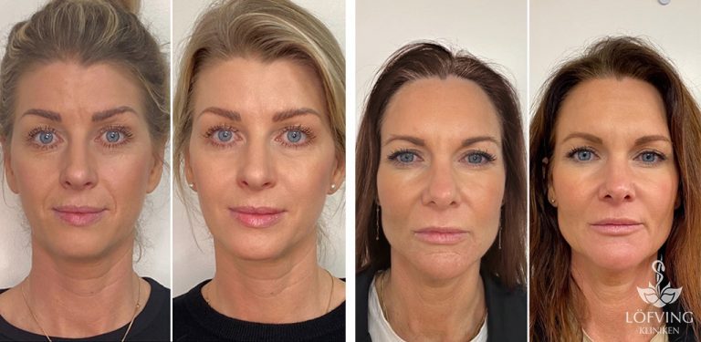 Fillers Göteborg - Läppförstoring, näsa & tear through - Löfvingkliniken